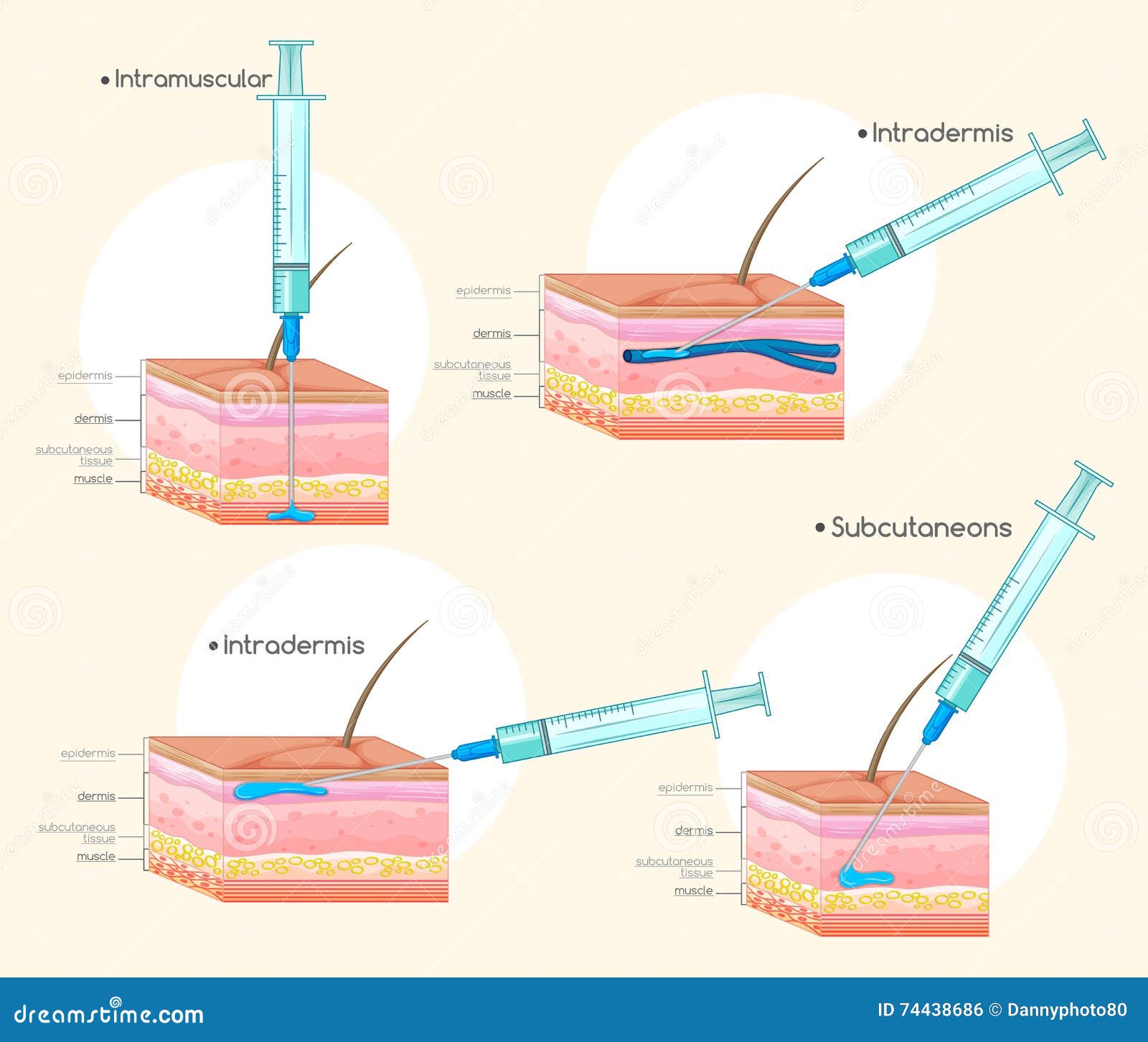 Différents Types D'injections Illustration de Vecteur - Illustration du ...