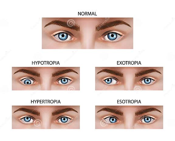 Différents Types De Strabisme. Illustration Stock - Illustration du ...