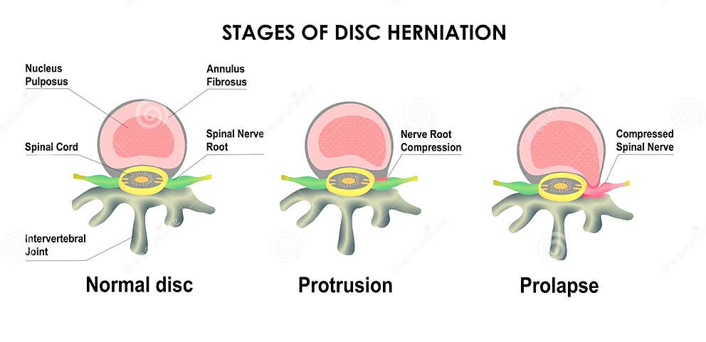 Difference between Bulging Disc and Herniated Disc. Stages of Spinal ...