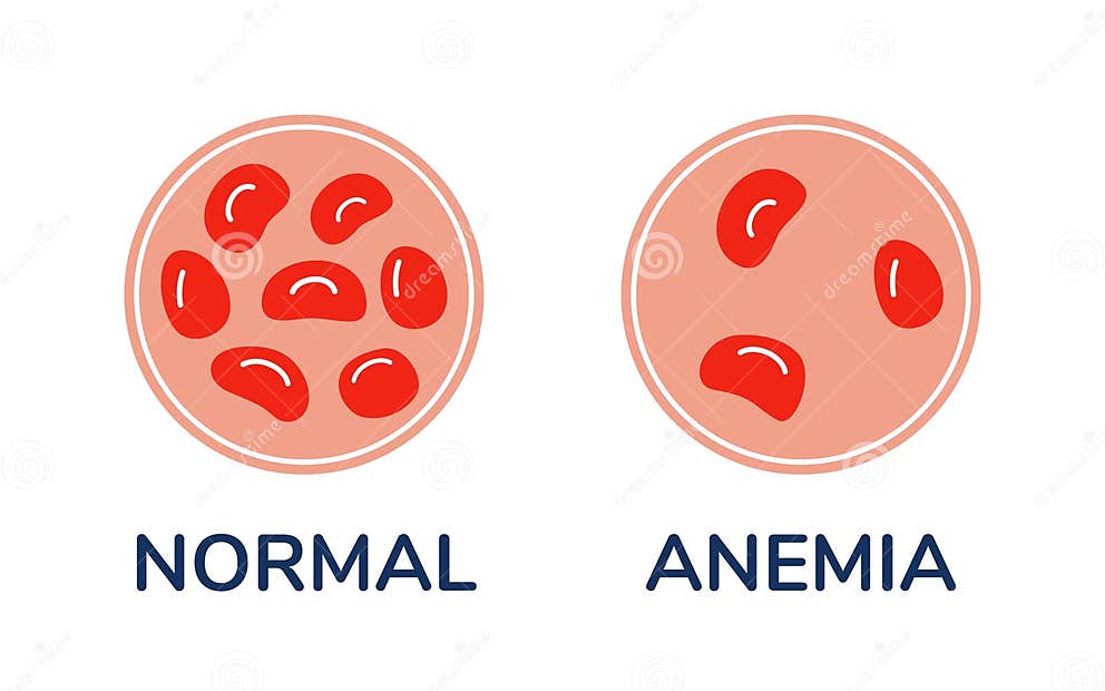 The Difference Comparison of a Drop of Blood with Normal and Anemic ...