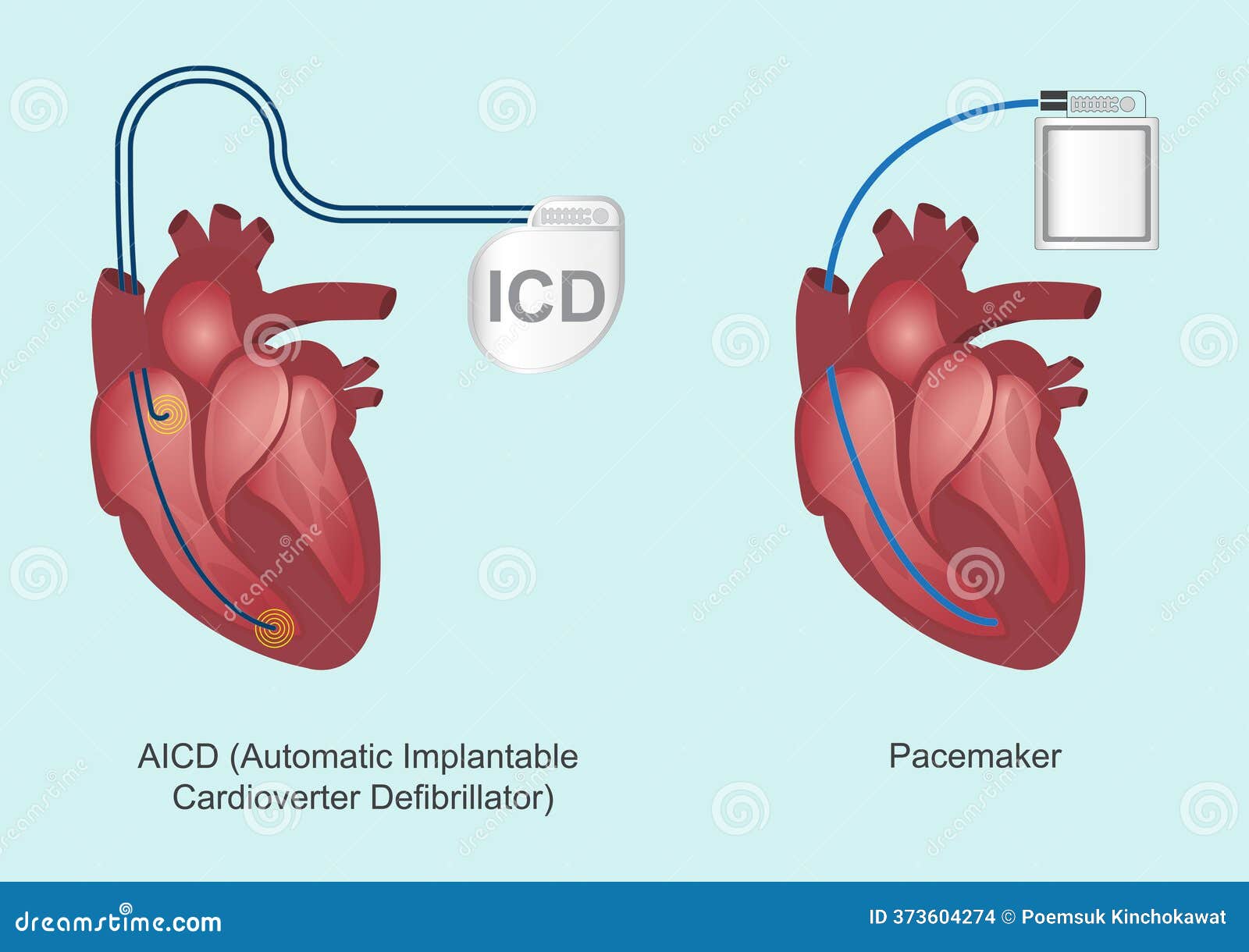 The Difference Between ICDs And Pacemakers Vector Illustration | CartoonDealer.com #373604274