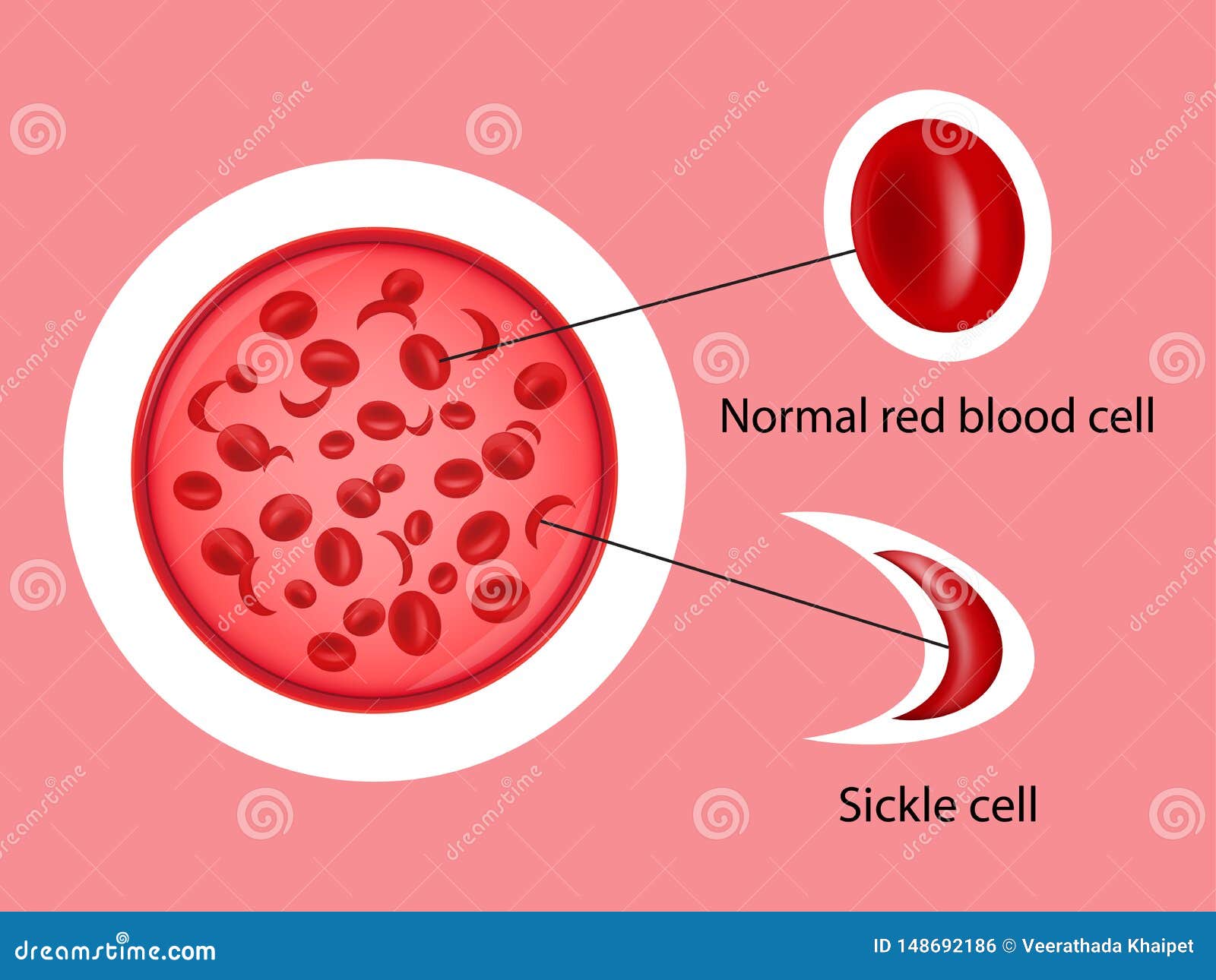 Difference Of Normal Red Blood Cells And Sickle Cells Vector ...