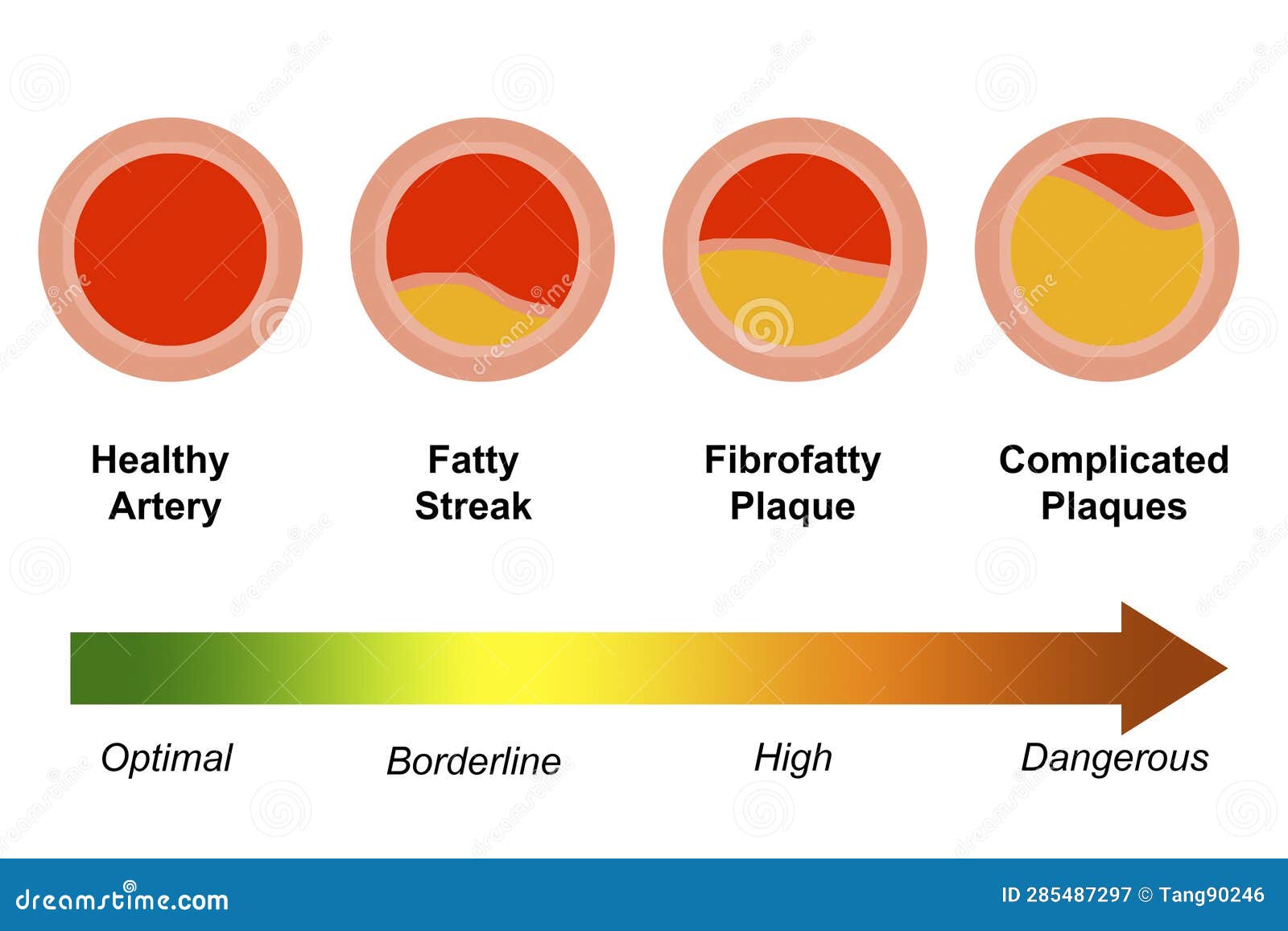 Atherosclerosis Stages Explanation And Fatty Plaque Formation Outline ...
