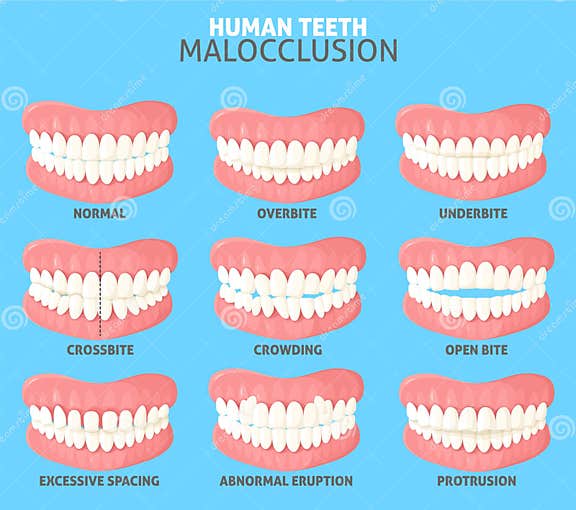 Different Human Teeth Malocclusion Types Front View Set Stock Vector