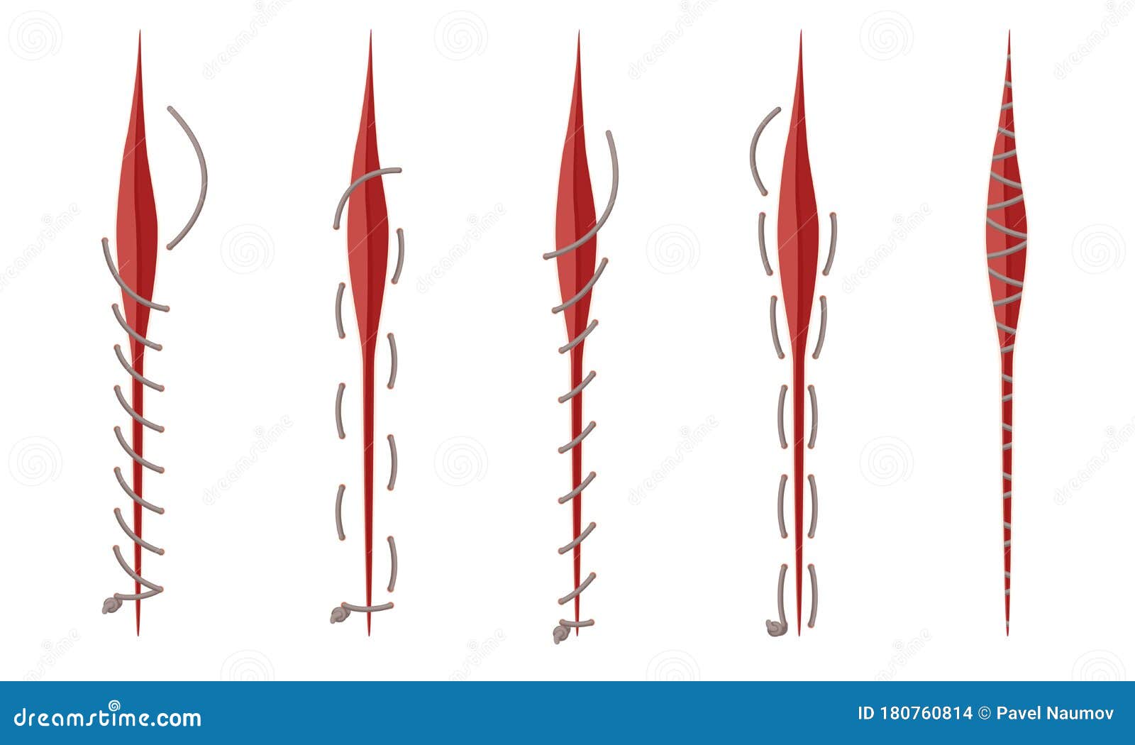 Surgical Stitches Infographic Set Vector Illustration | CartoonDealer ...