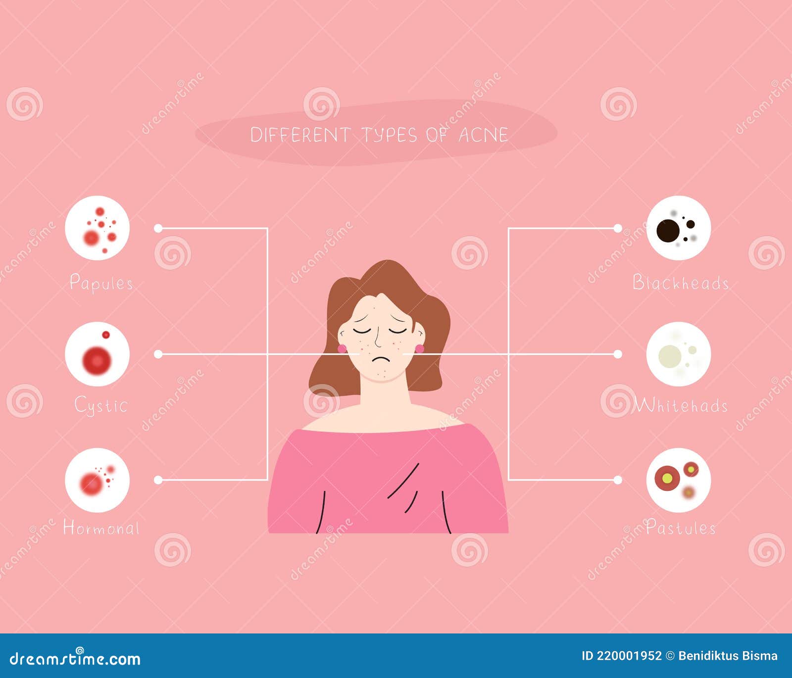 Acne Infographic Vector 137286445