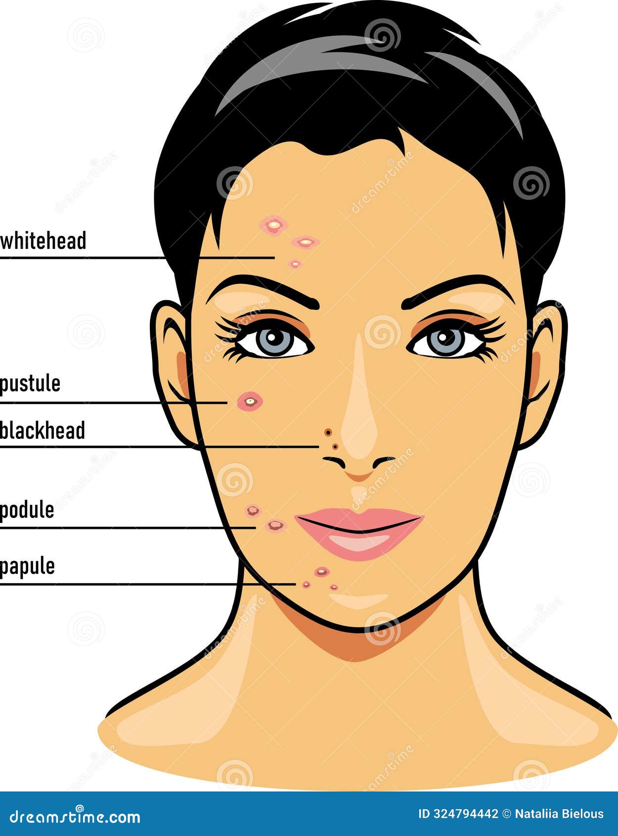 Types Of Acne On Woman Face With Icon Set Of Acne Pimple Vector