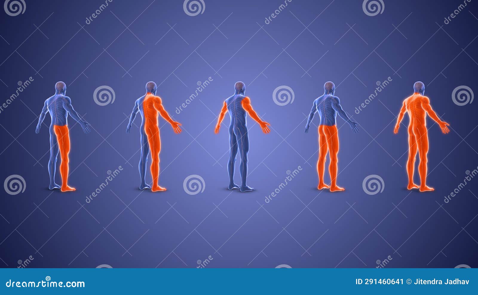 Paralysis. Quadriplegia, Paraplegia, Hemiplegia, Monoplegia, And ... Paralysis. Quadriplegia, Paraplegia, Hemiplegia, Monoplegia, And ...