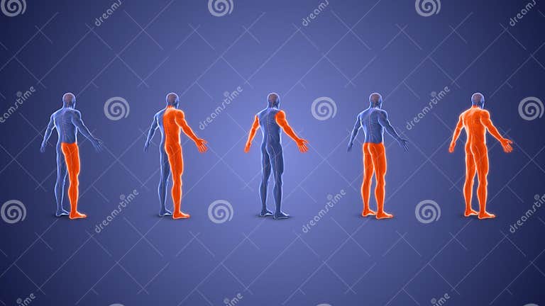 Different Types of Paralysis Condition Medical Concept Stock ...