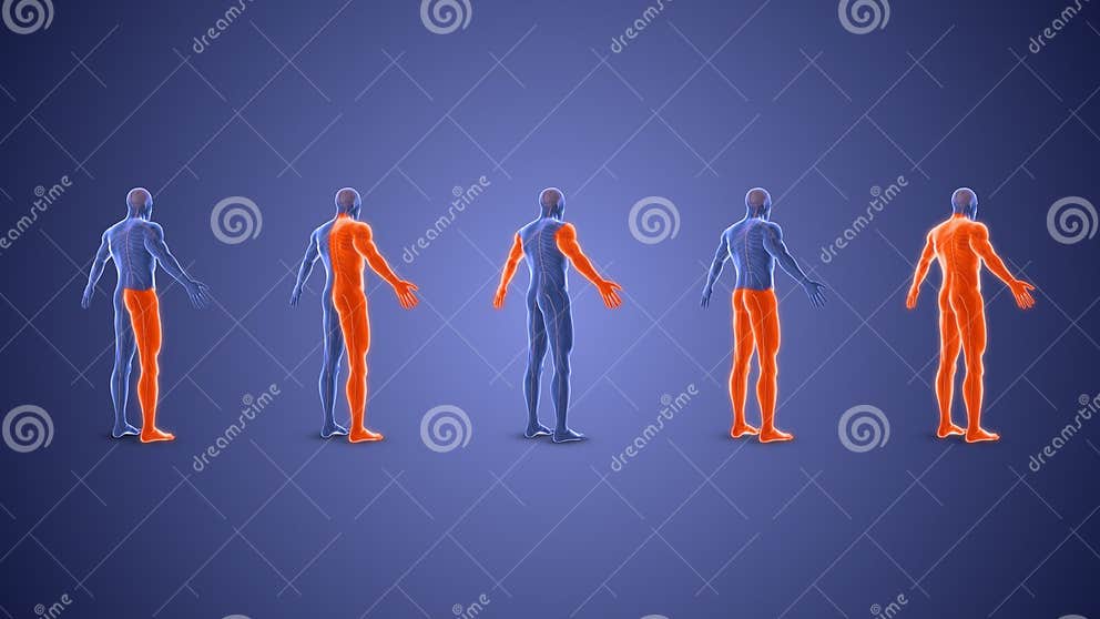 Different Types of Paralysis Condition Medical Concept Stock ...