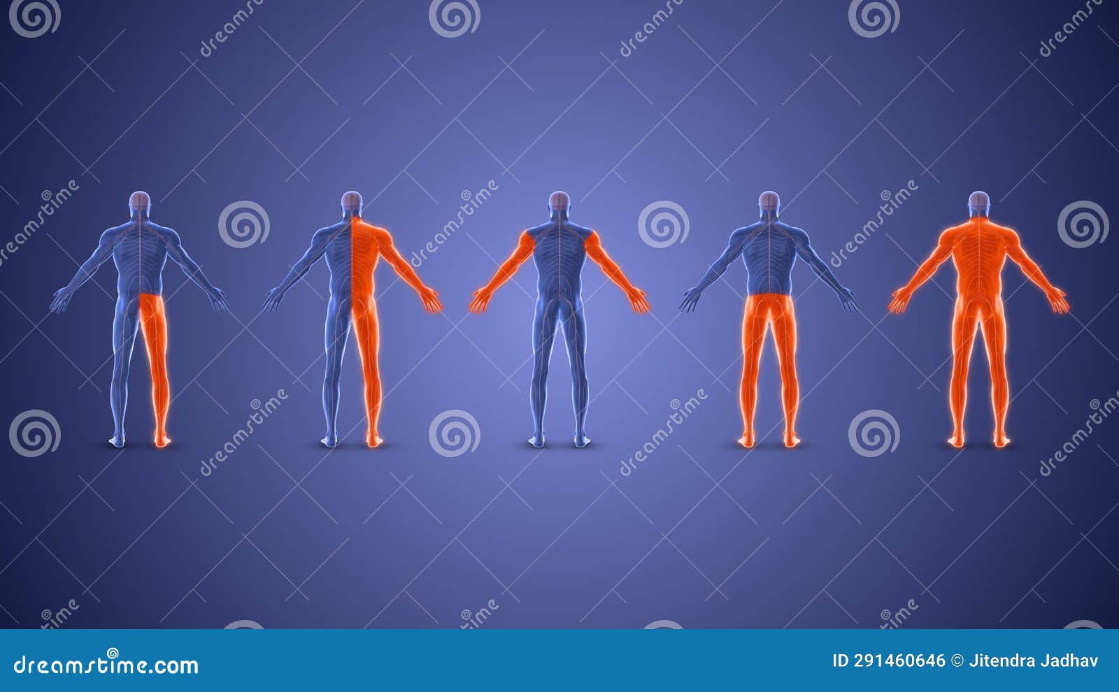 Paralysis. Quadriplegia, Paraplegia, Hemiplegia, Monoplegia, And ...