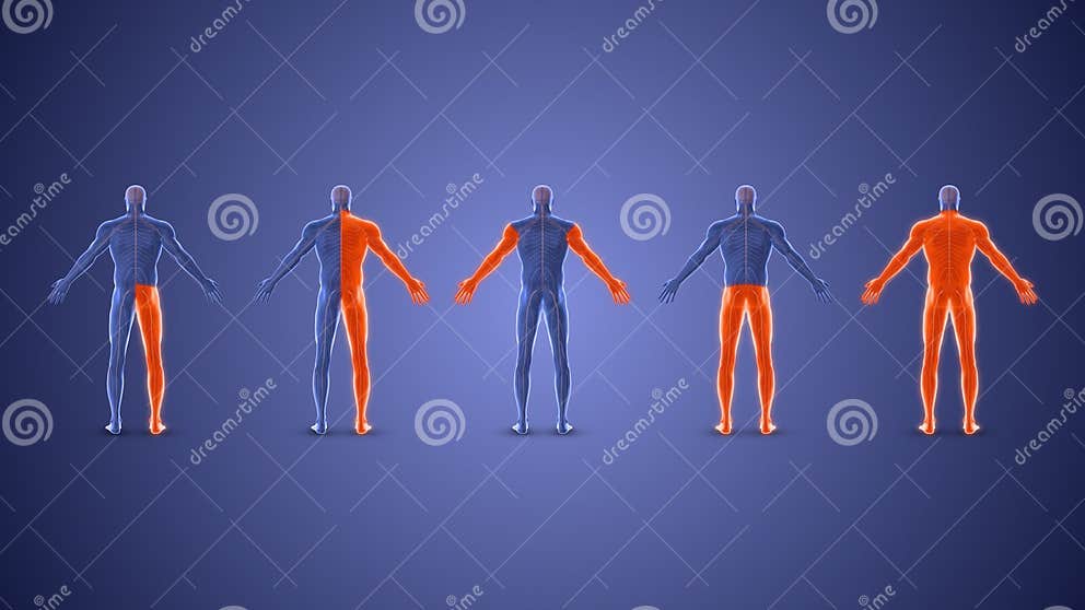 Different Types of Paralysis Condition Medical Concept Stock ...