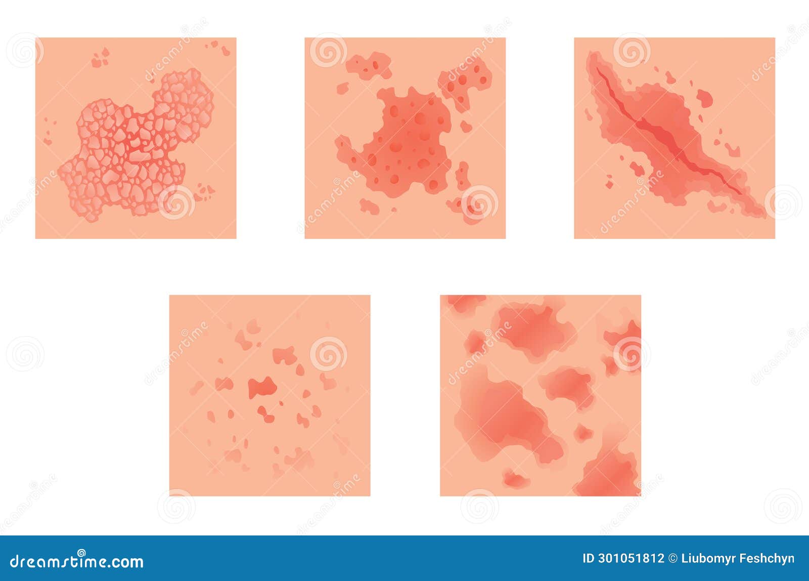 Different Types of Psoriasis Vector Set. Part of Patients Skin with ...