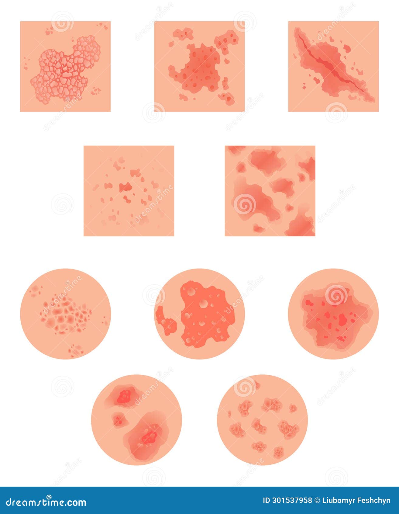Different Types of Psoriasis Vector Set. Part of Patients Skin with ...