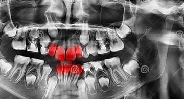 Different Types of Wisdom Teeth Problems Concept. Problem Teeth X-ray ...