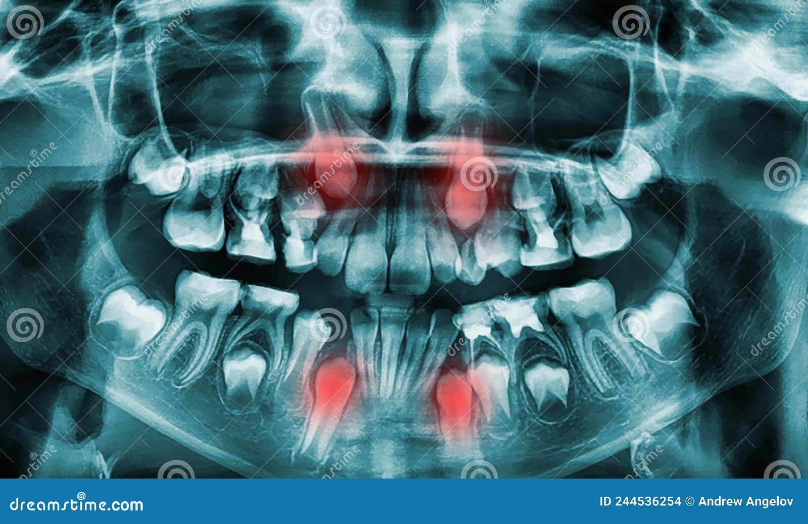 Different Types of Wisdom Teeth Problems Concept. Problem Teeth X-ray ...