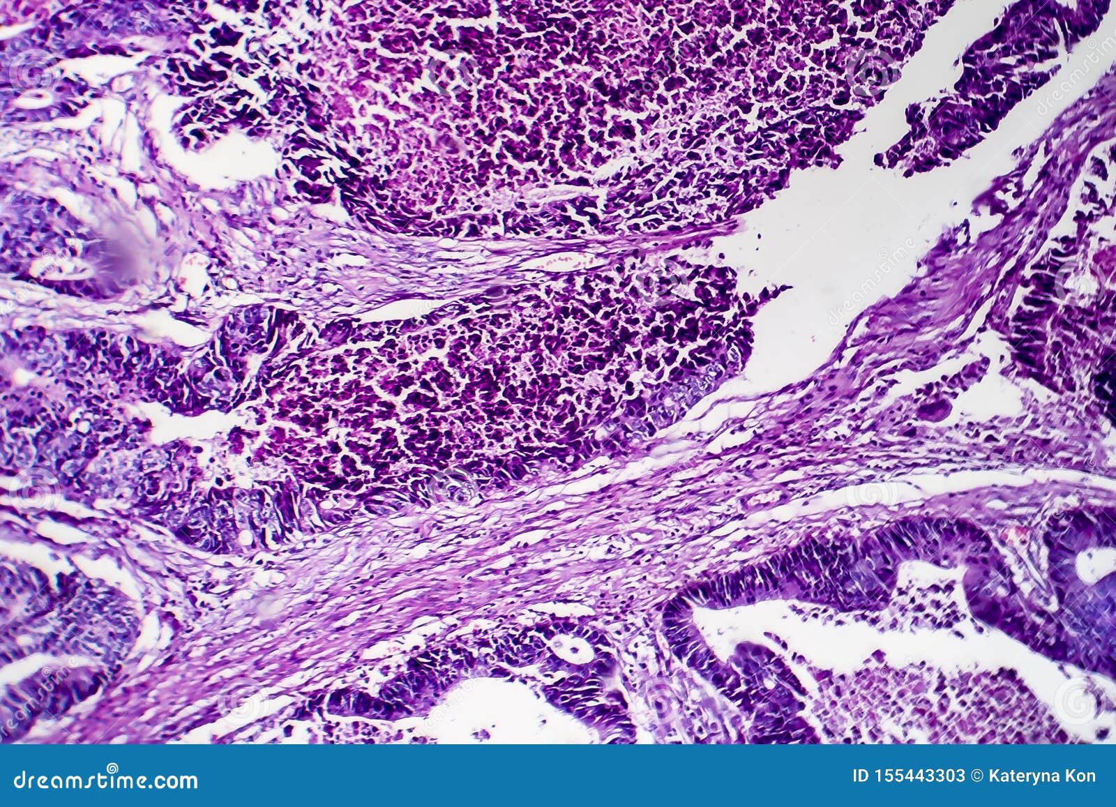 Differentiated Intestinal Adenocarcinoma, Light Micrograph Royalty-Free ...