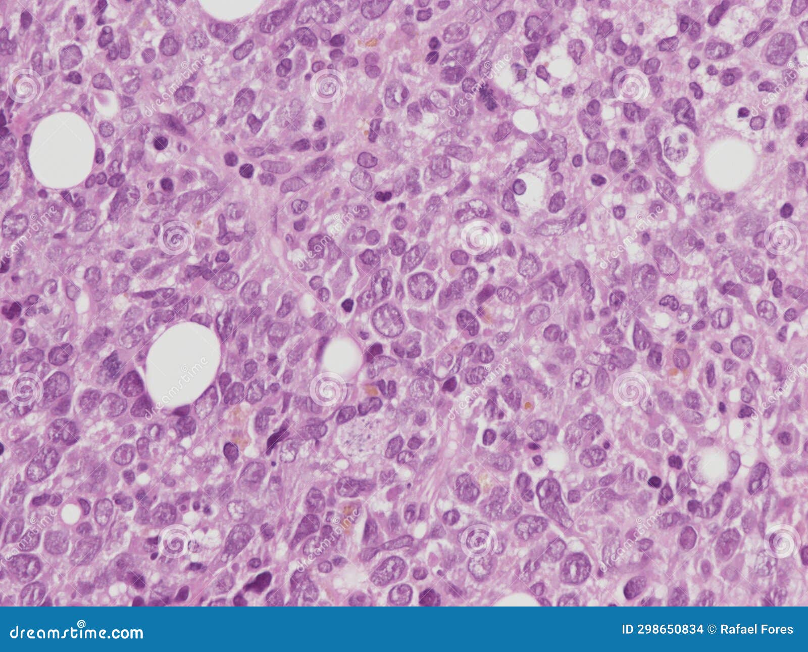 Diffuse Large B Cell Lymphoma, Bone Marrow. Stock Photo - Image of ...