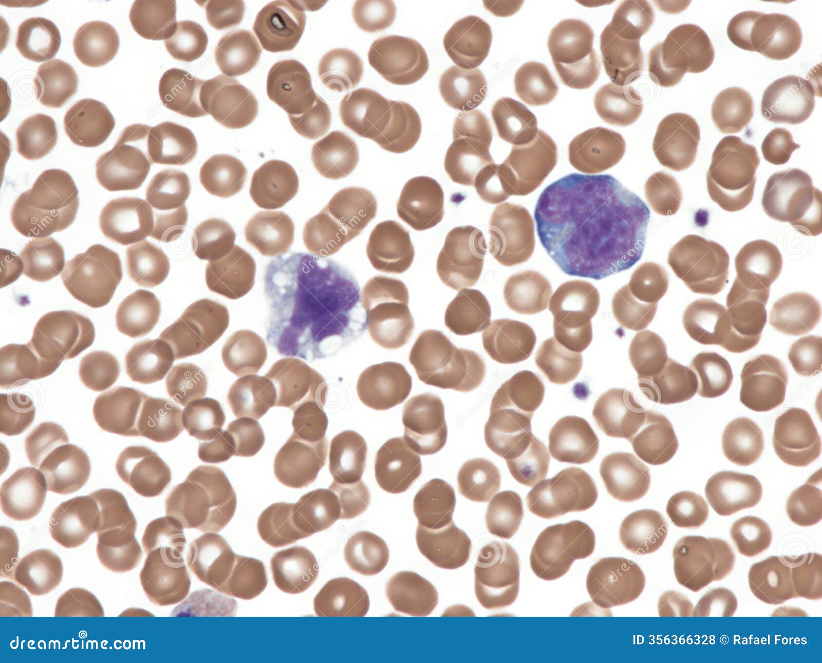 Diffuse Large B-cell Lymphoma in Peripheral Blood. Stock Photo - Image ...
