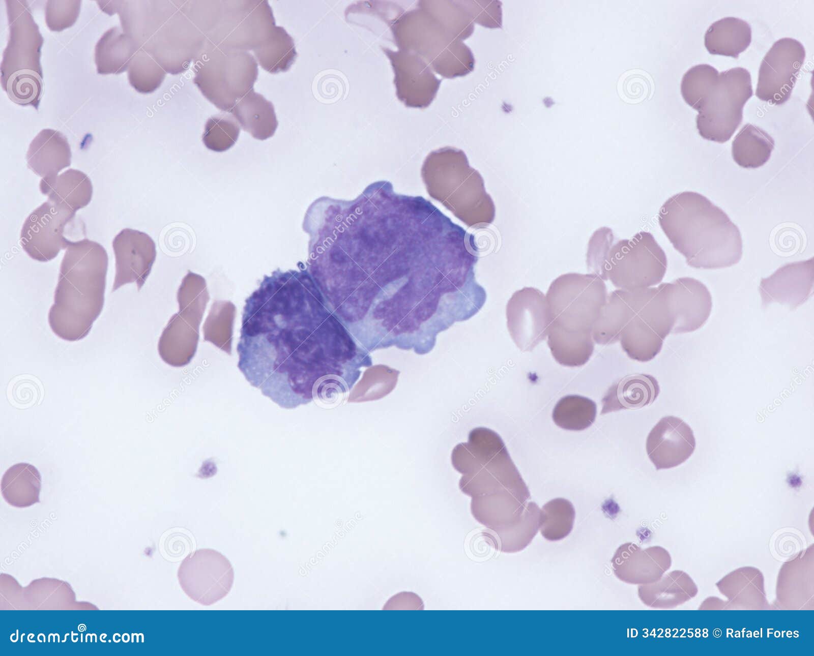 Diffuse Large B Cell Lymphoma, Peripheral Blood. Stock Photo - Image of ...