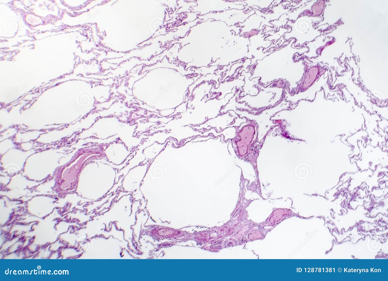 Diffuse Emphysema, Light Micrograph Stock Image - Image of emphysema ...
