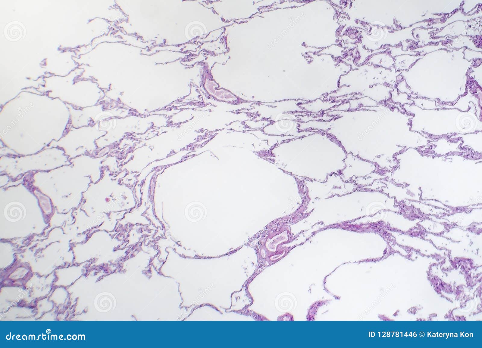 Diffuse Emphysema, Light Micrograph Stock Photo - Image of alveoli ...
