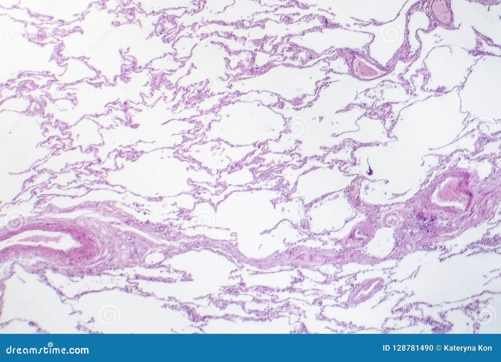 Diffuse Emphysema, Light Micrograph Stock Photo - Image of ...