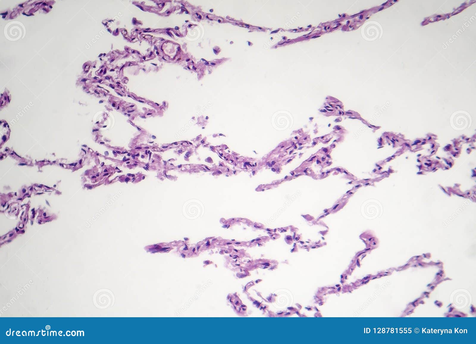 Diffuse Emphysema, Light Micrograph Stock Image - Image of pulmonary ...