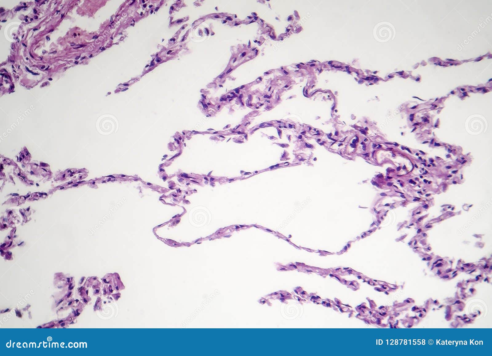 Diffuse Emphysema, Light Micrograph Stock Photo - Image of tissue ...