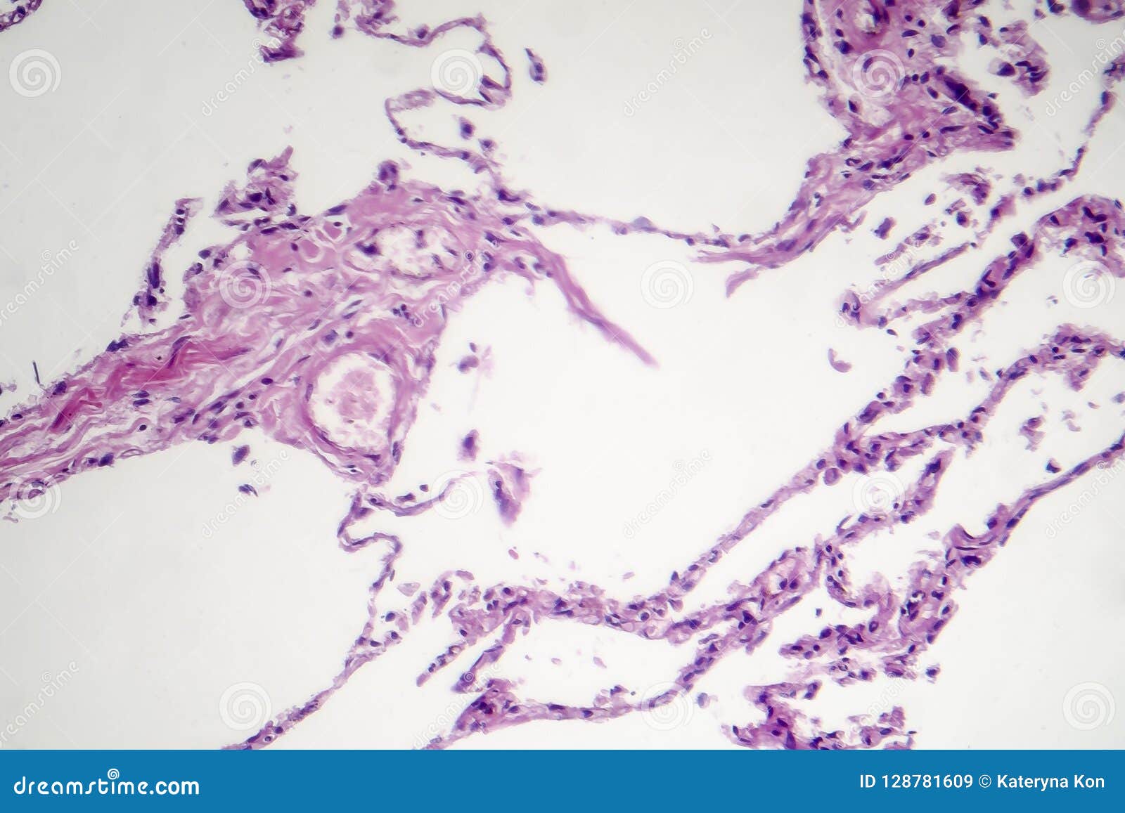 Diffuse Emphysema, Light Micrograph Stock Image - Image of micro ...