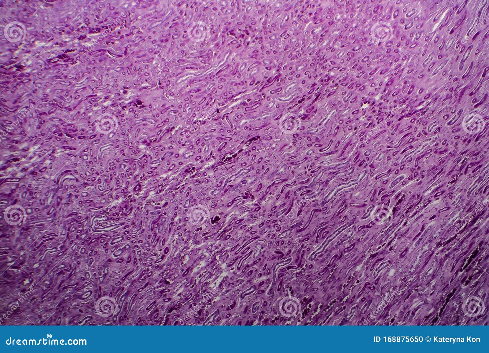 Diffuse Proliferative Glomerulonephritis Stock Photo - Image of ...