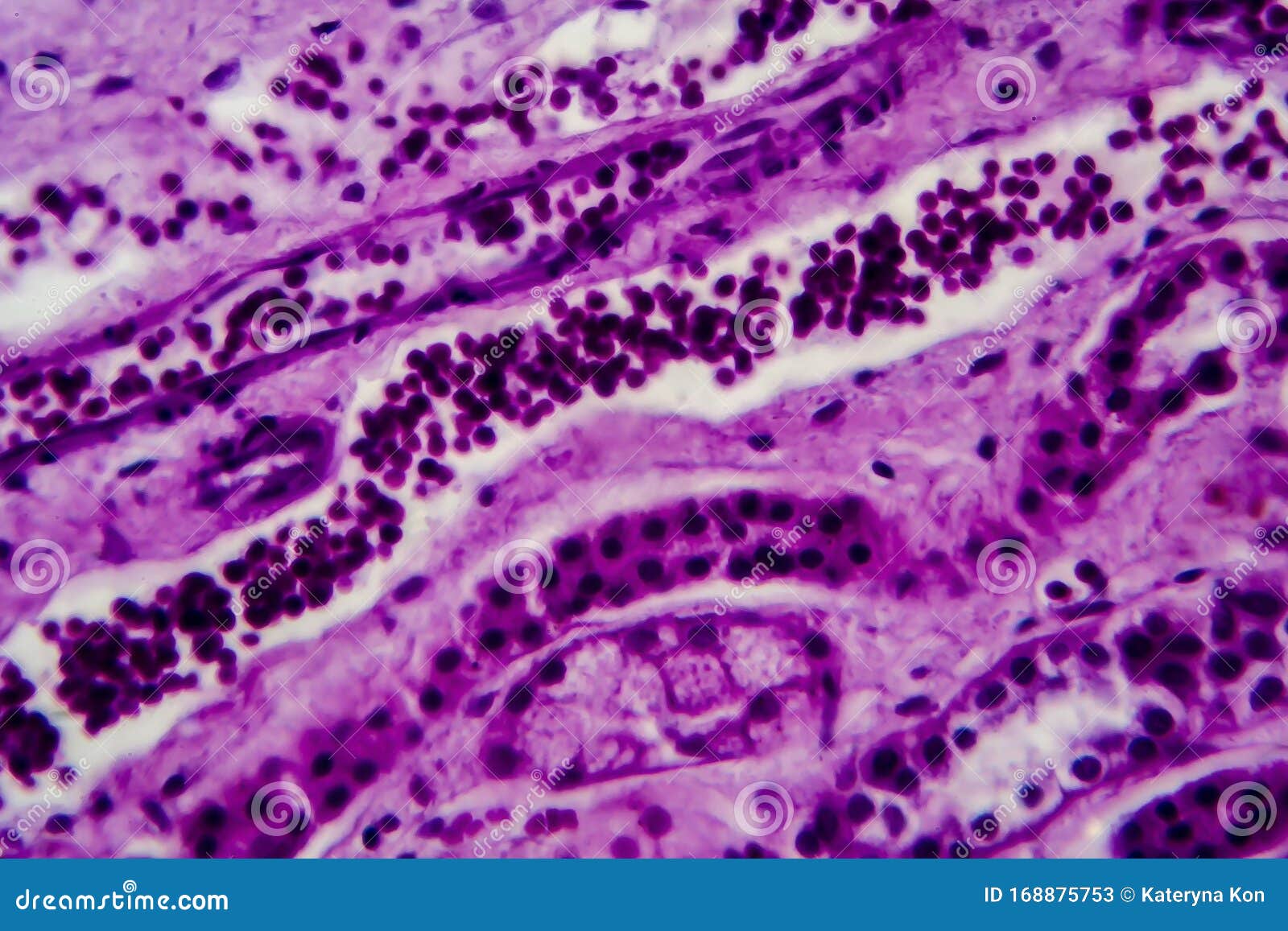 Diffuse Proliferative Glomerulonephritis Stock Image - Image of ...