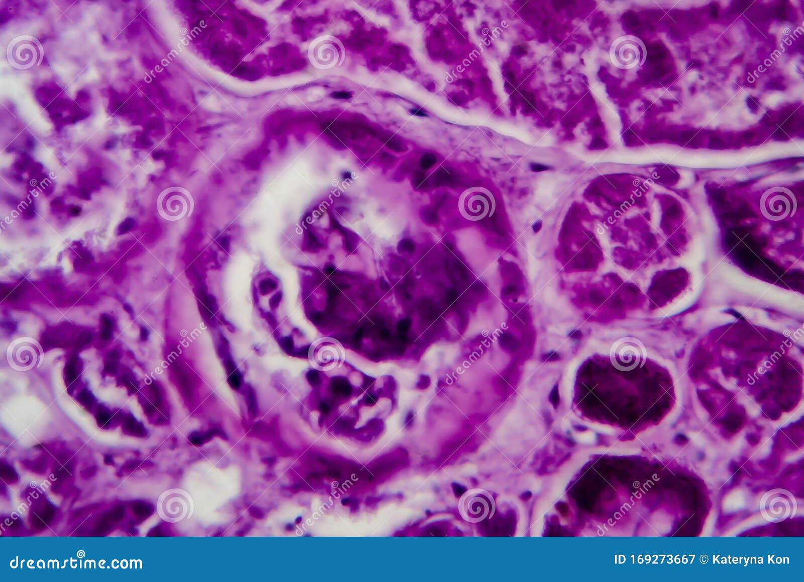 A LE Cell (lupus Erythematosus Cell) In Bone Marrow. Royalty-Free Stock ...