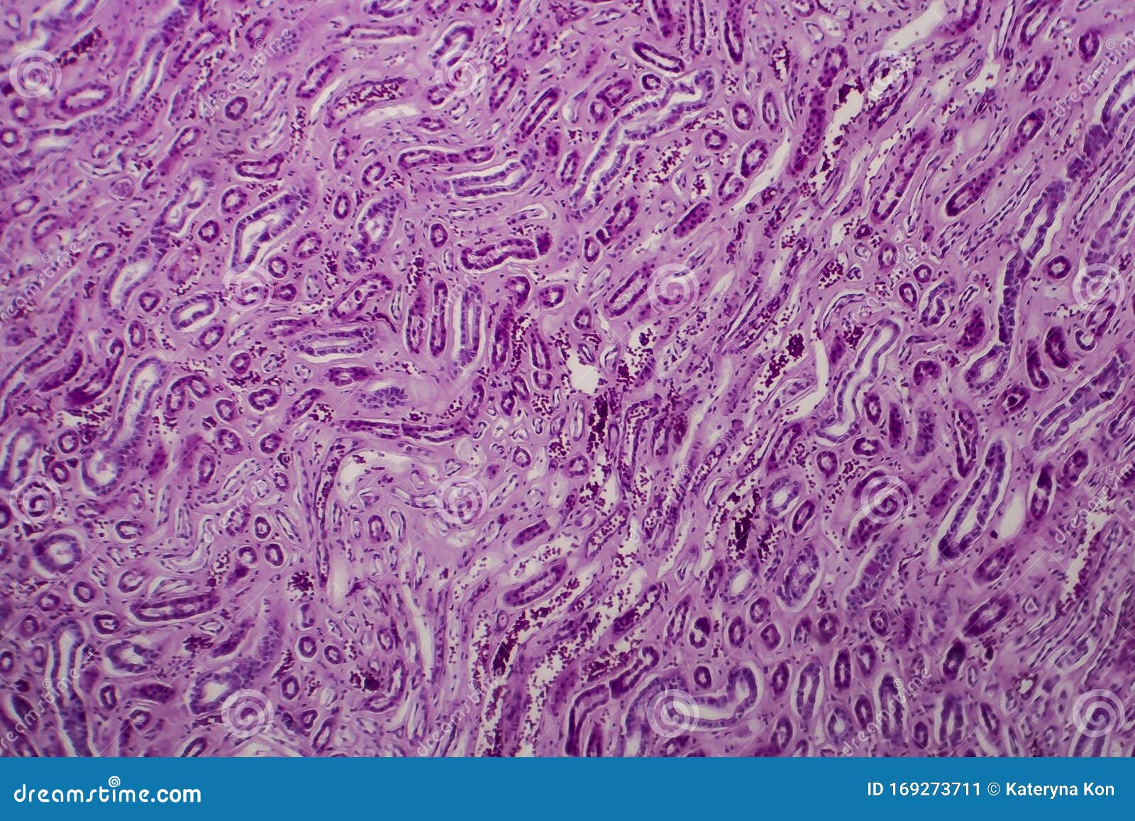 Diffuse Proliferative Glomerulonephritis Stock Image - Image of ...