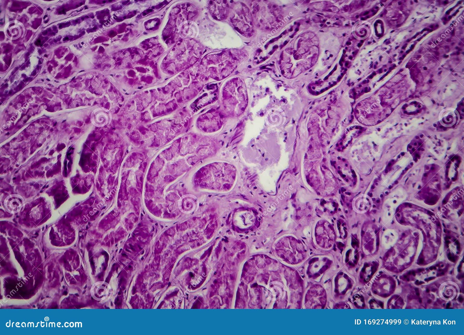 Diffuse Proliferative Glomerulonephritis Stock Image - Image of ...