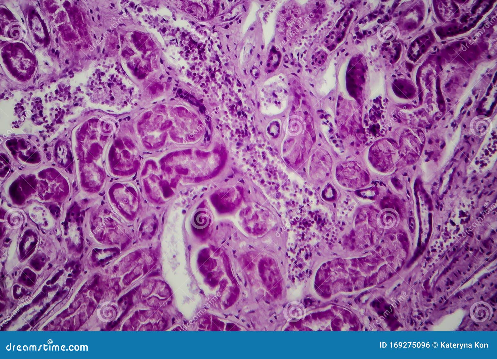 Diffuse Proliferative Glomerulonephritis Stock Photo - Image of kidney ...