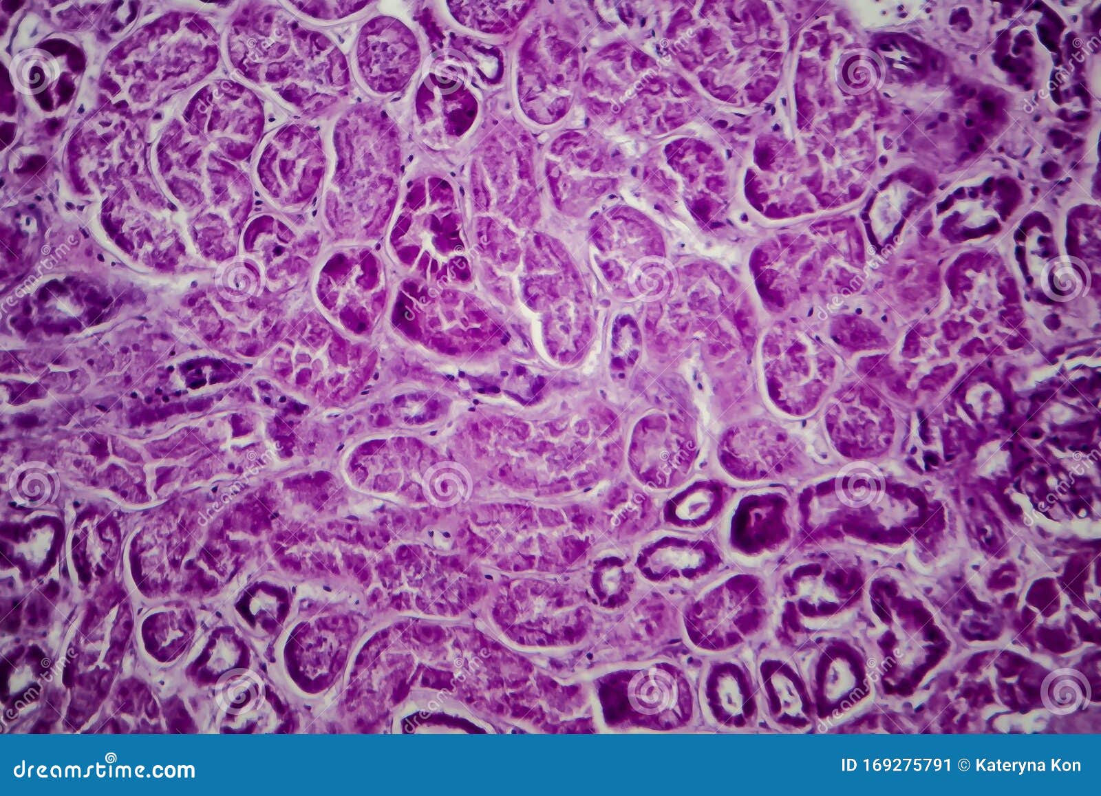 Diffuse Proliferative Glomerulonephritis Stock Image - Image of tissue ...