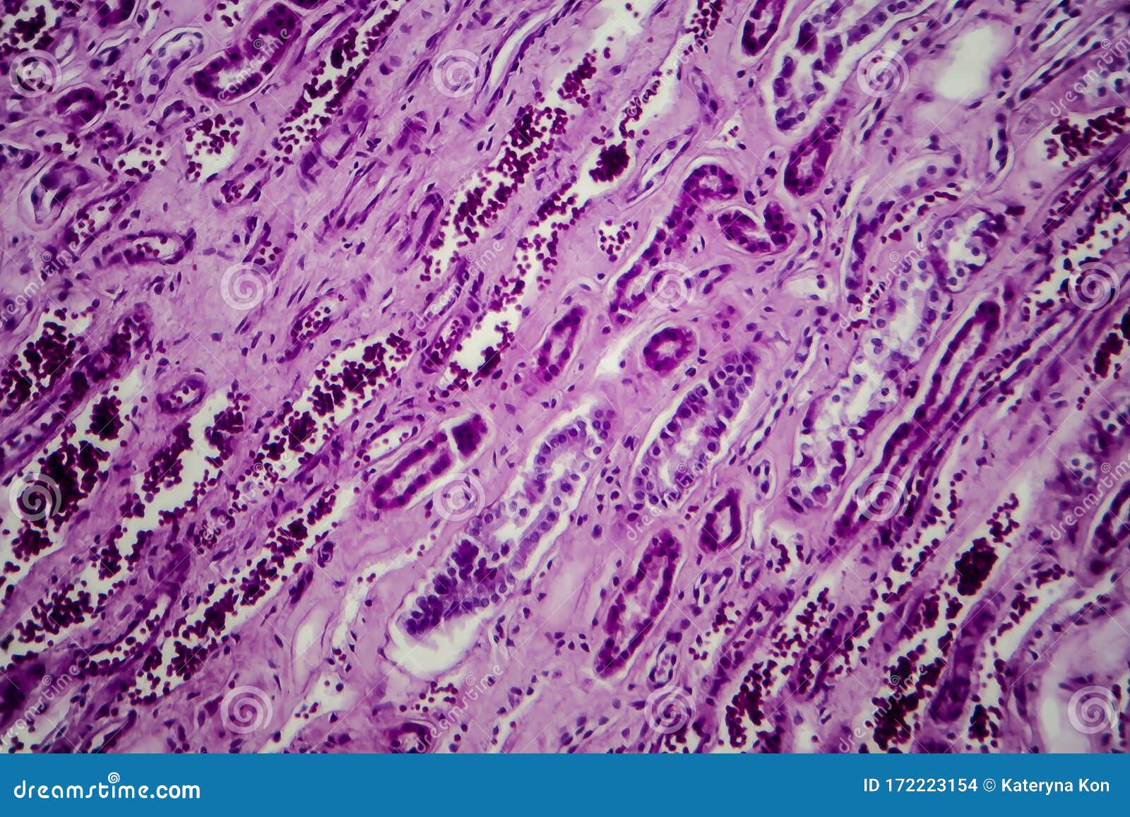 Diffuse Proliferative Glomerulonephritis Stock Photo - Image of ...