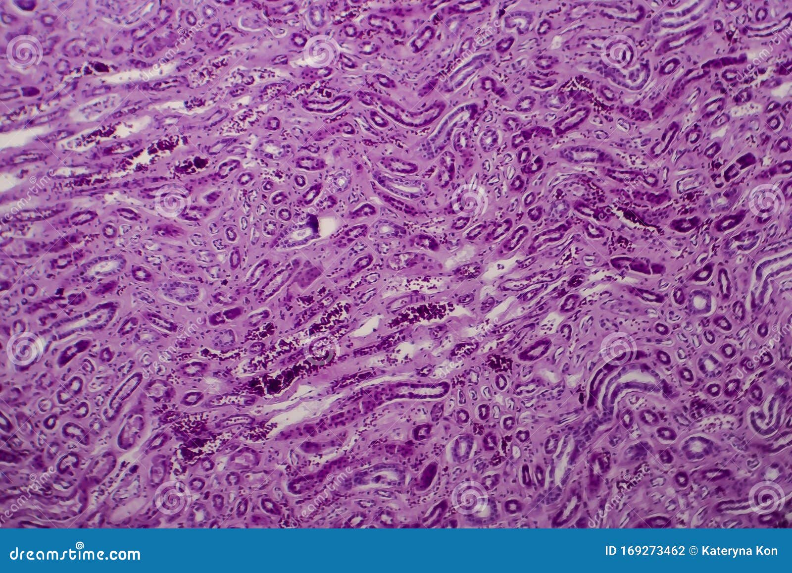 Diffuse Proliferative Glomerulonephritis Stock Photo - Image of eosin ...