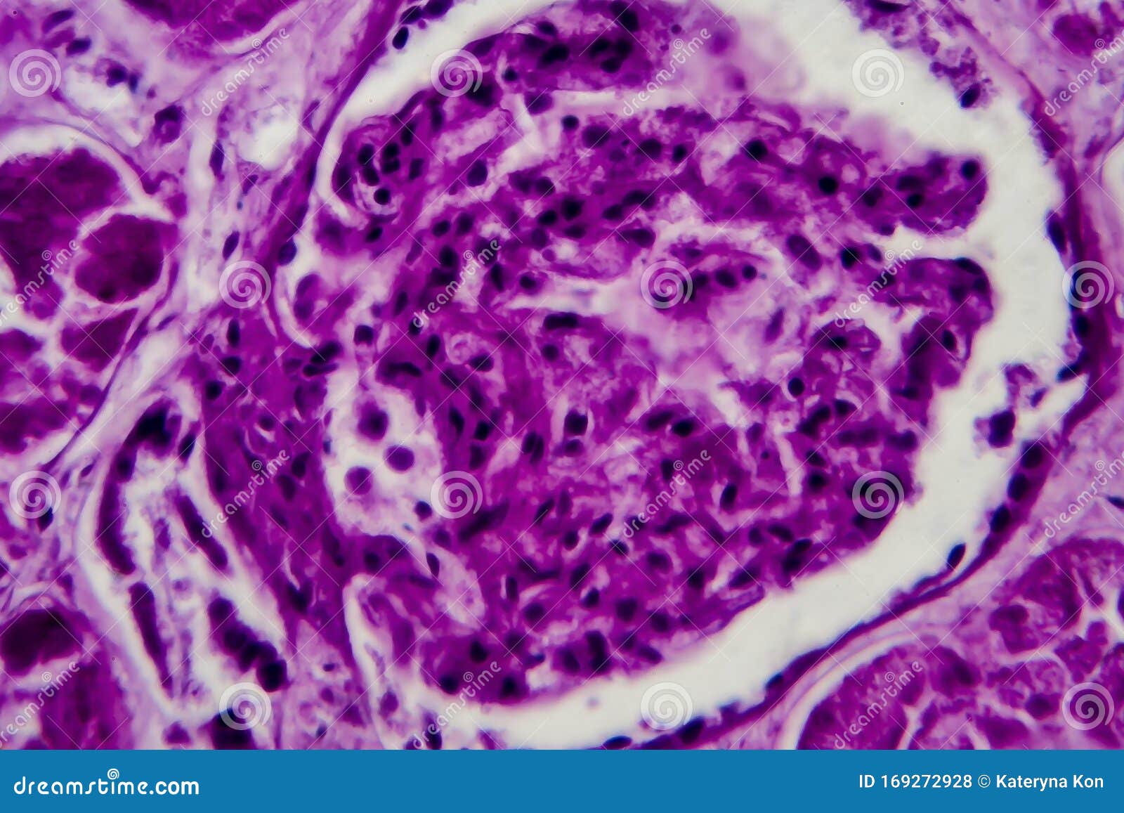 Diffuse Proliferative Glomerulonephritis Em