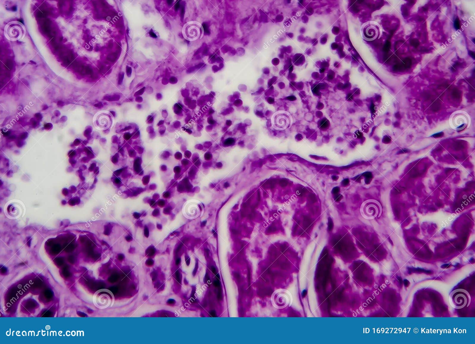 Diffuse Proliferative Glomerulonephritis Stock Image - Image of ...