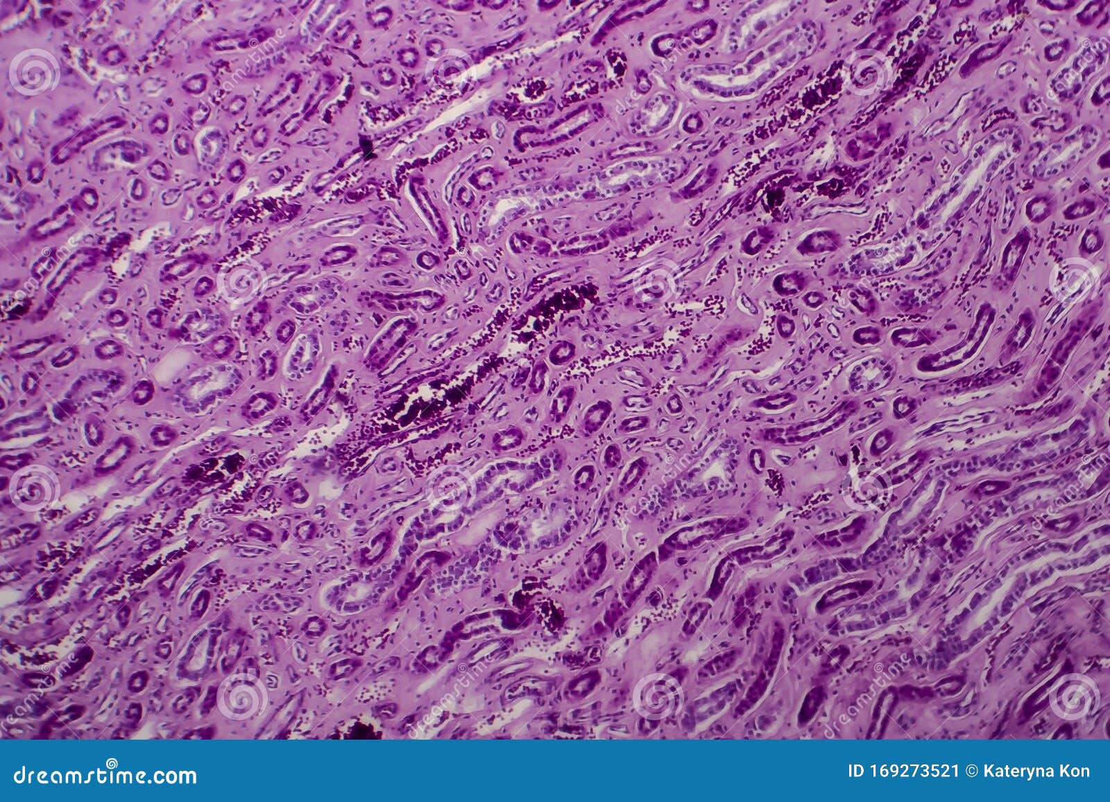 Diffuse Proliferative Glomerulonephritis Stock Image - Image of disease ...