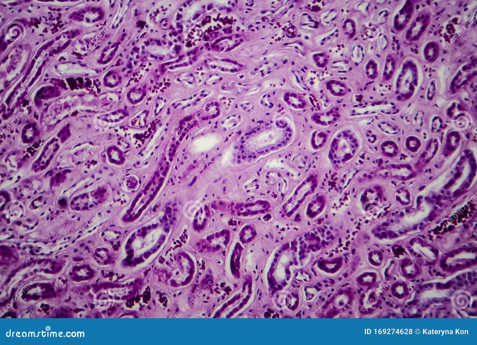 Diffuse Proliferative Glomerulonephritis Stock Photo - Image of ...