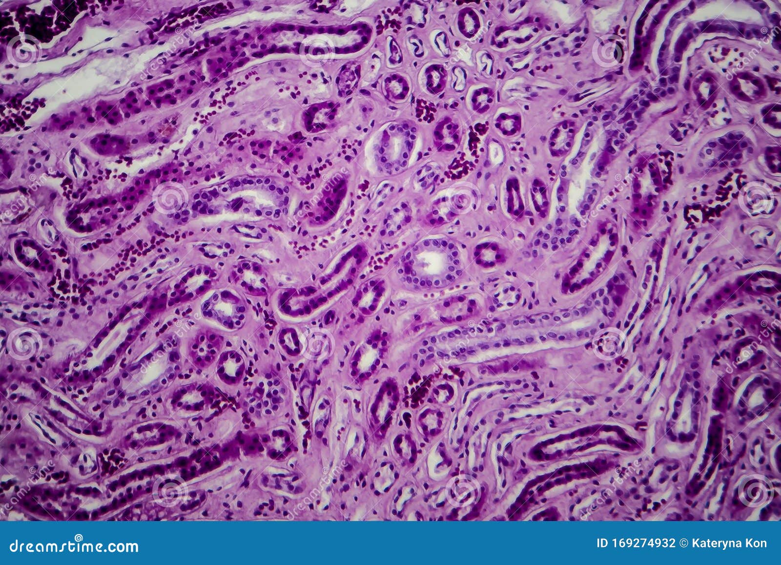 Diffuse Proliferative Glomerulonephritis Stock Photo - Image of ...