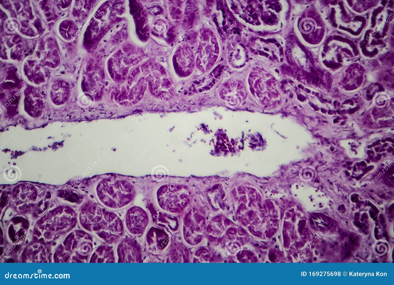 Diffuse Proliferative Glomerulonephritis Stock Photo - Image of renal ...