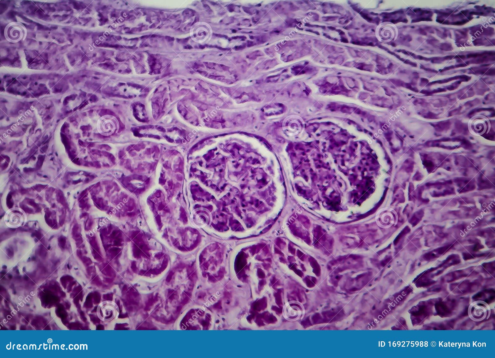 Diffuse Proliferative Glomerulonephritis Stock Photo - Image of kidney ...