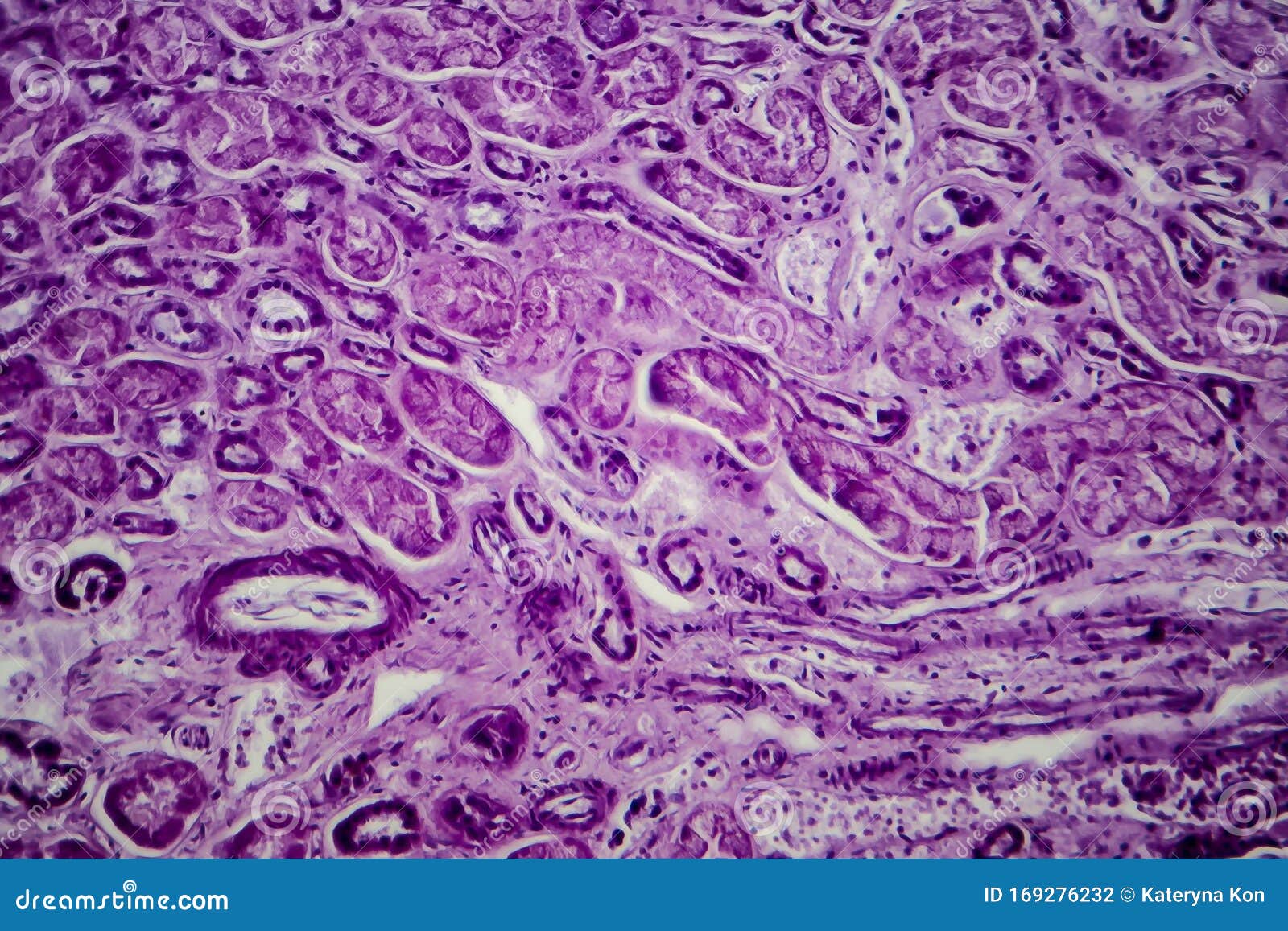 Diffuse Proliferative Glomerulonephritis Stock Photo - Image of ...