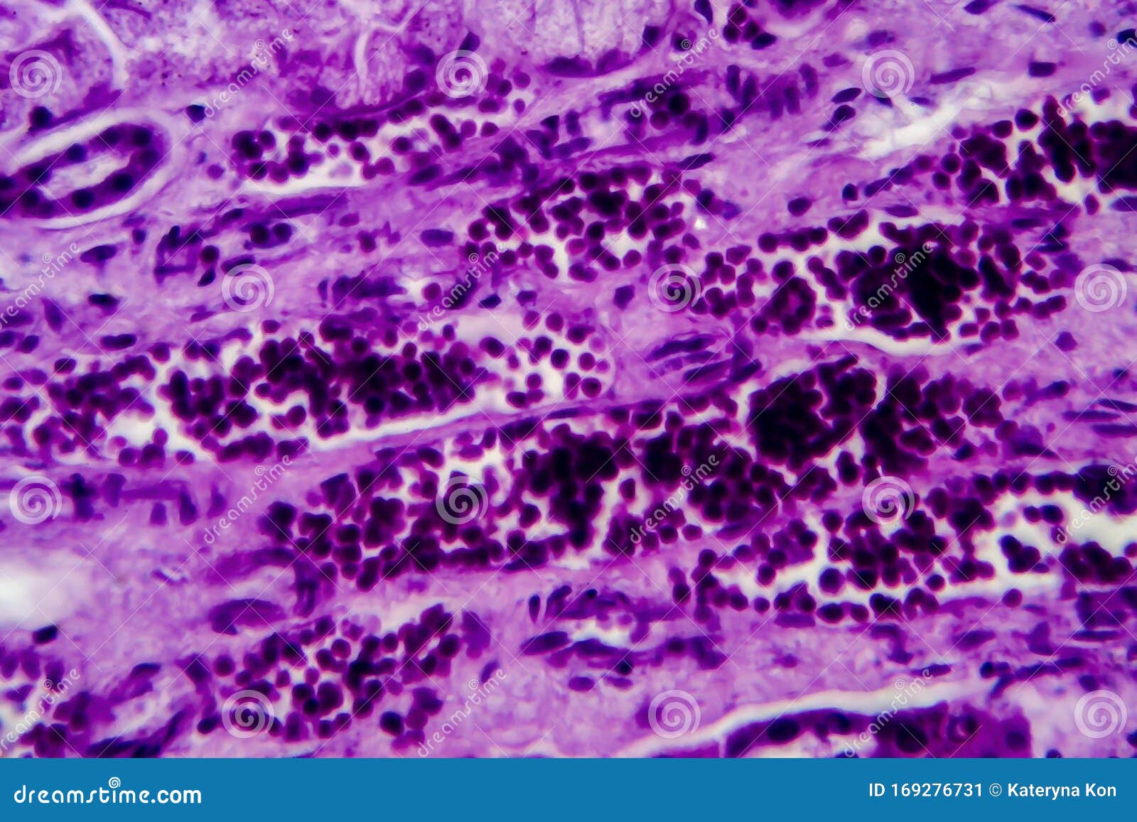 Diffuse Proliferative Glomerulonephritis Stock Image - Image of ...