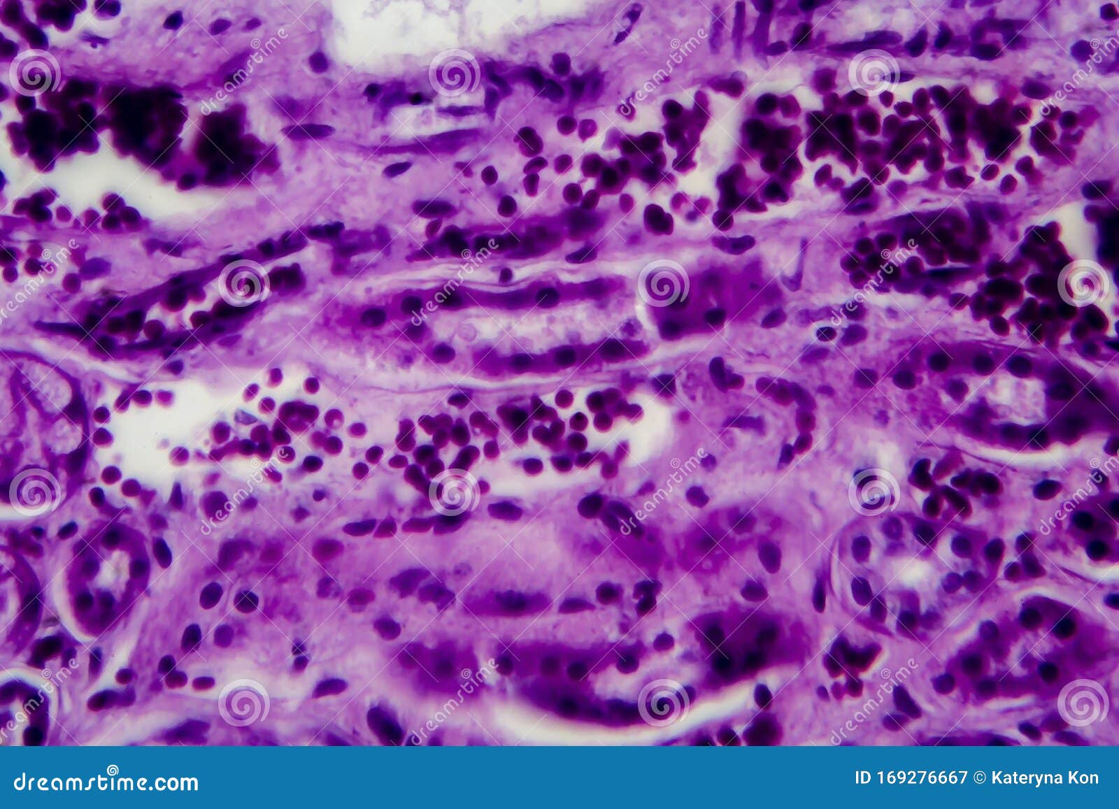 Diffuse Proliferative Glomerulonephritis Stock Image - Image of illness ...