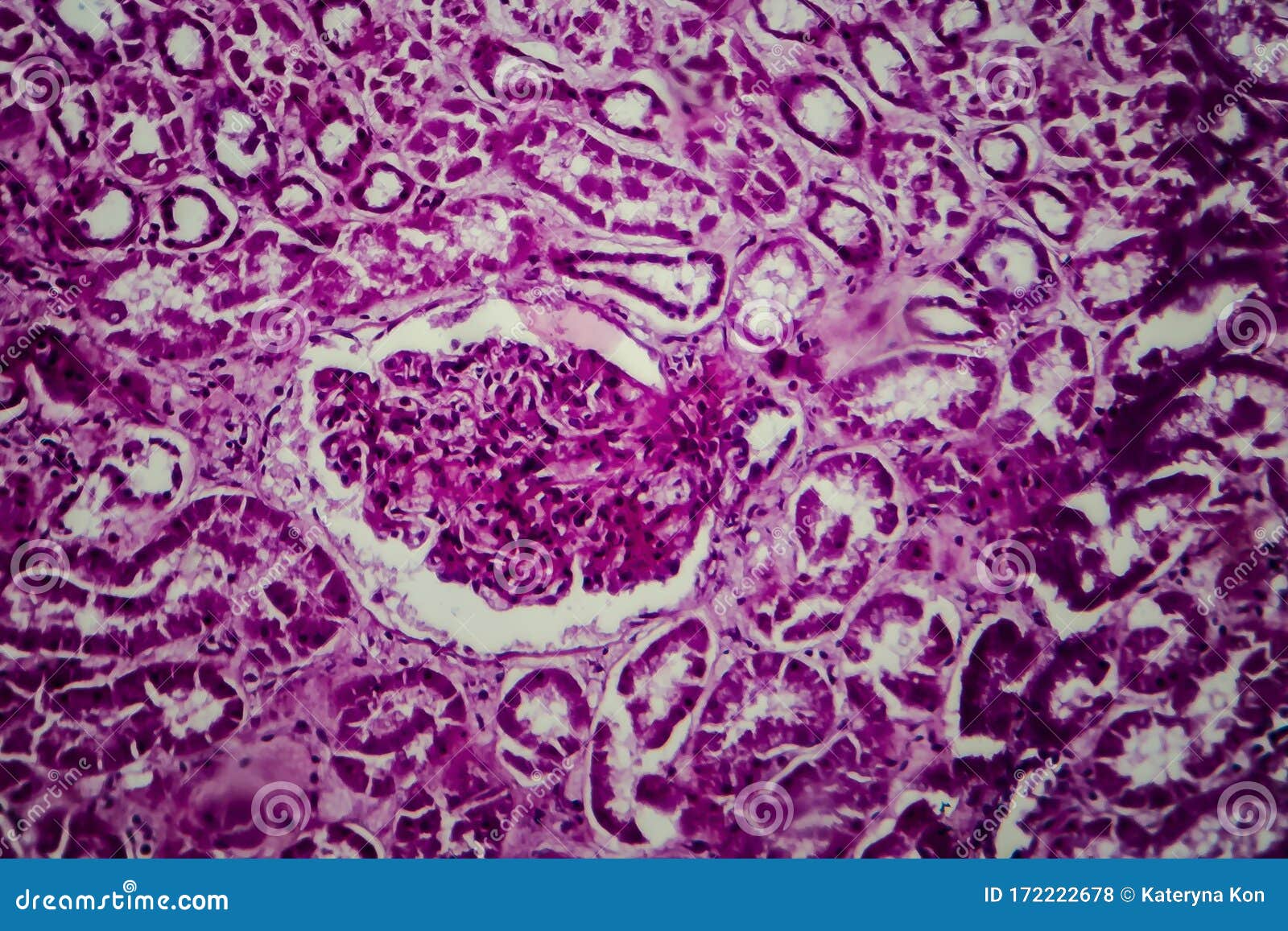 Diffuse Sclerosing Glomerulonephritis Stock Photo - Image of nephritis ...
